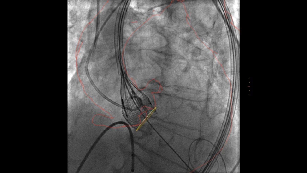 Valve ASSIST | GE HealthCare