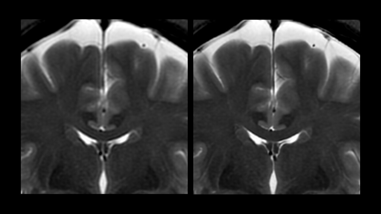 True-to-MR detail with AIR™ Recon DL | GE HealthCare