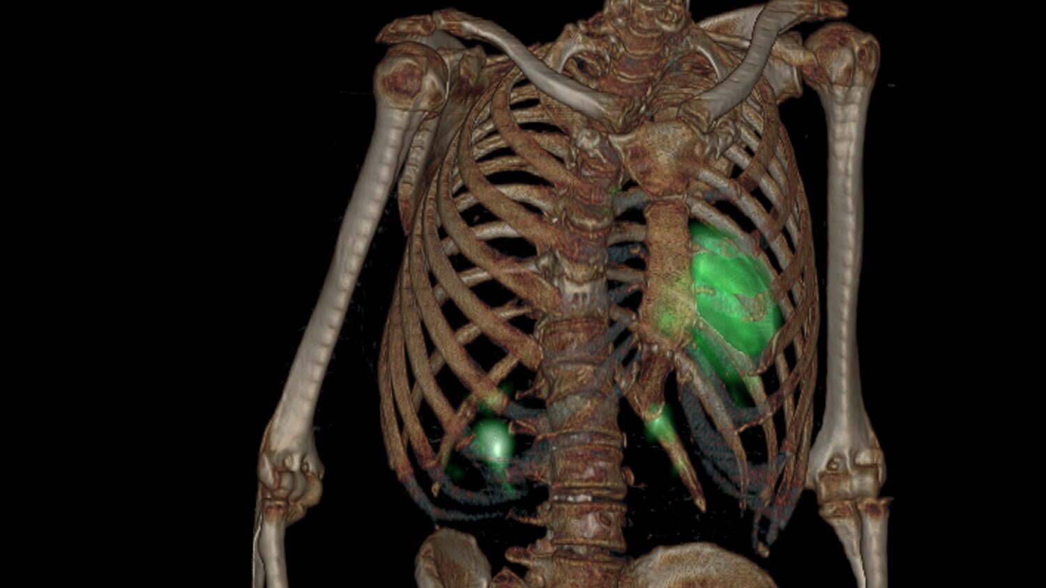 RT Advanced Visualization | GE HealthCare